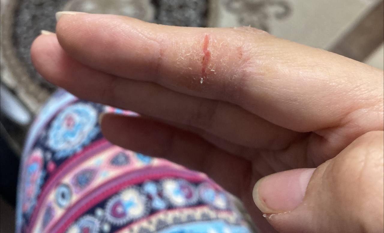 Eczema (ICD-10: L20-L30) - Online consultation AI dermatologist