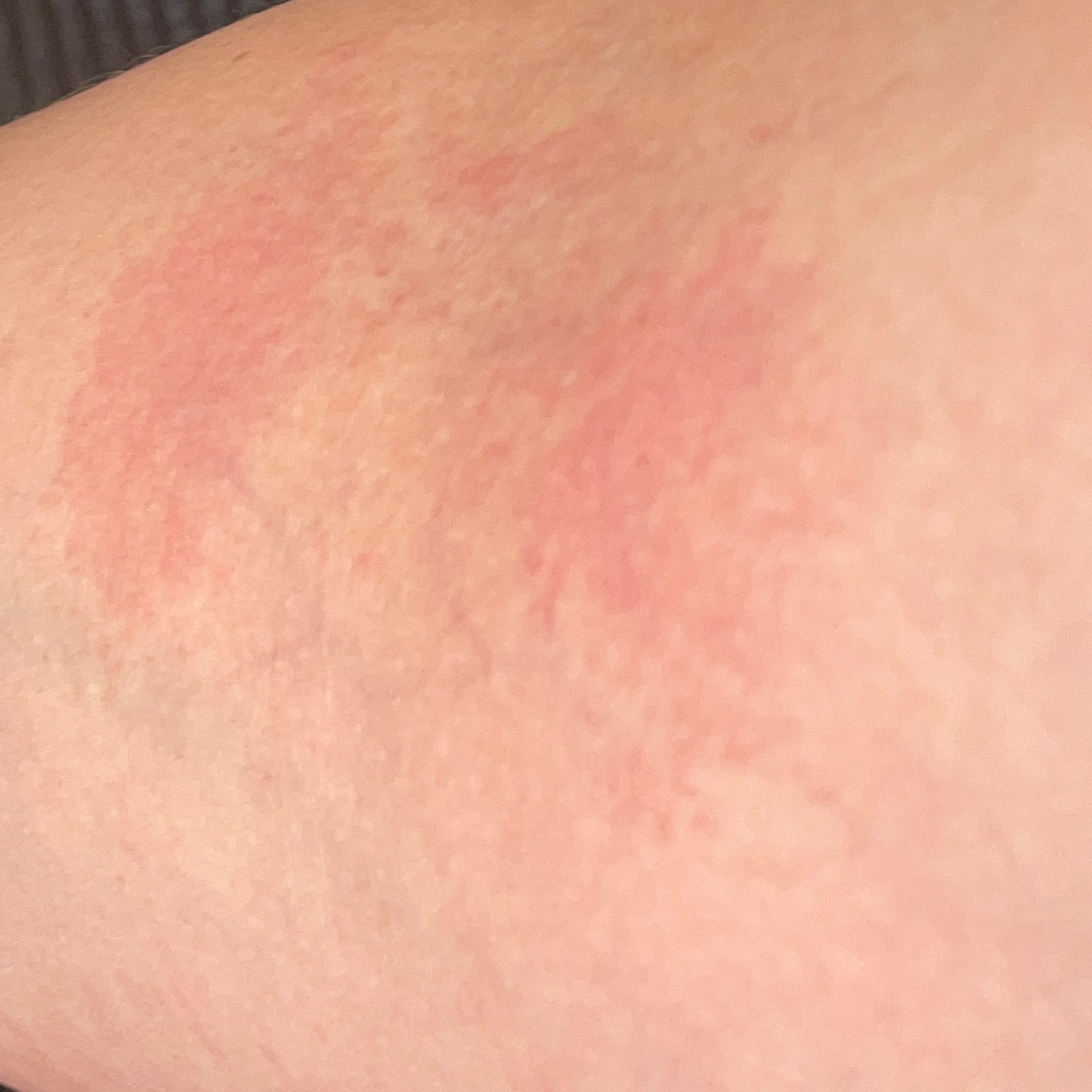 Dermatitis (ICD-10: L20-L30) - Online consultation AI dermatologist