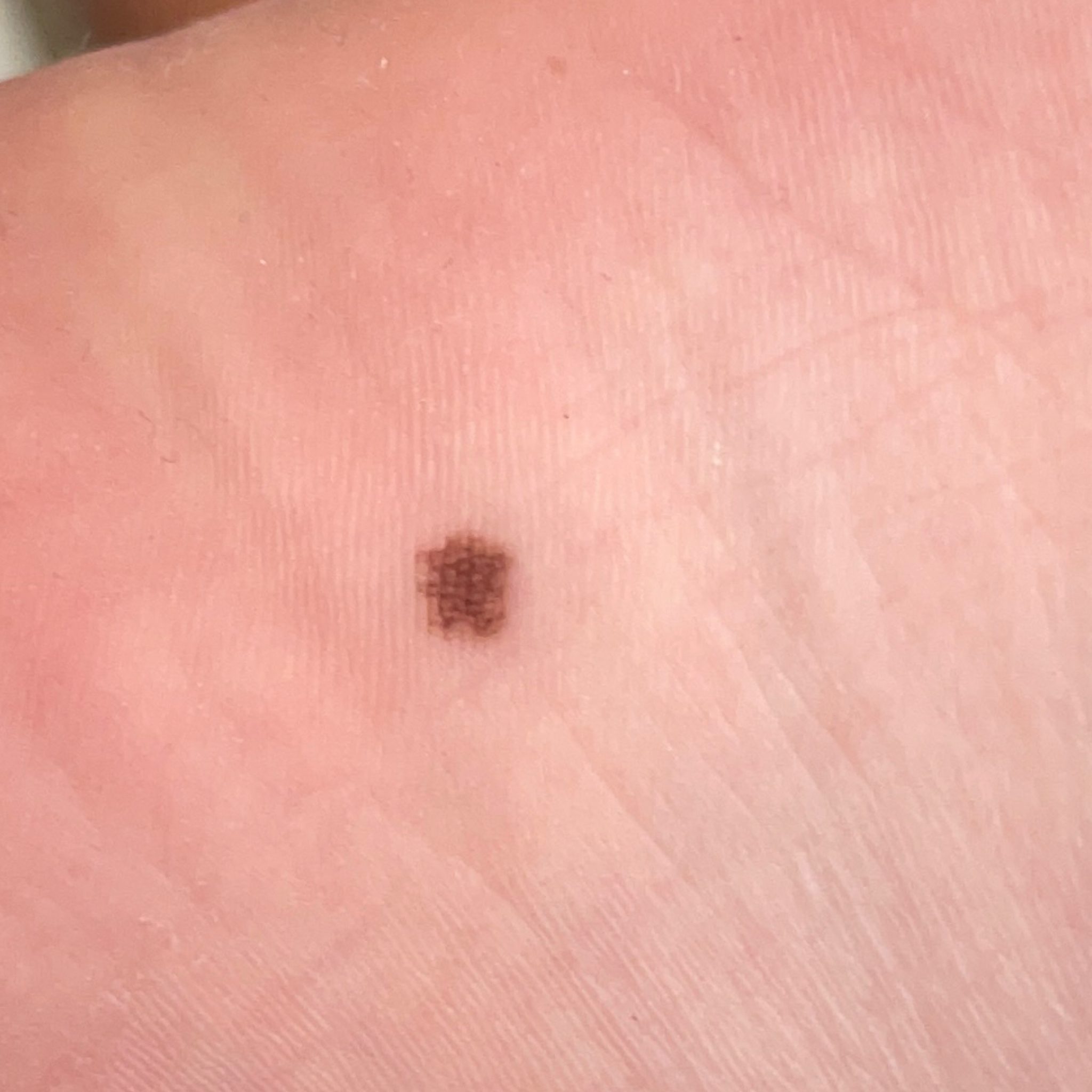 Acral Nevus (ICD-10: D22) - Skinive AI