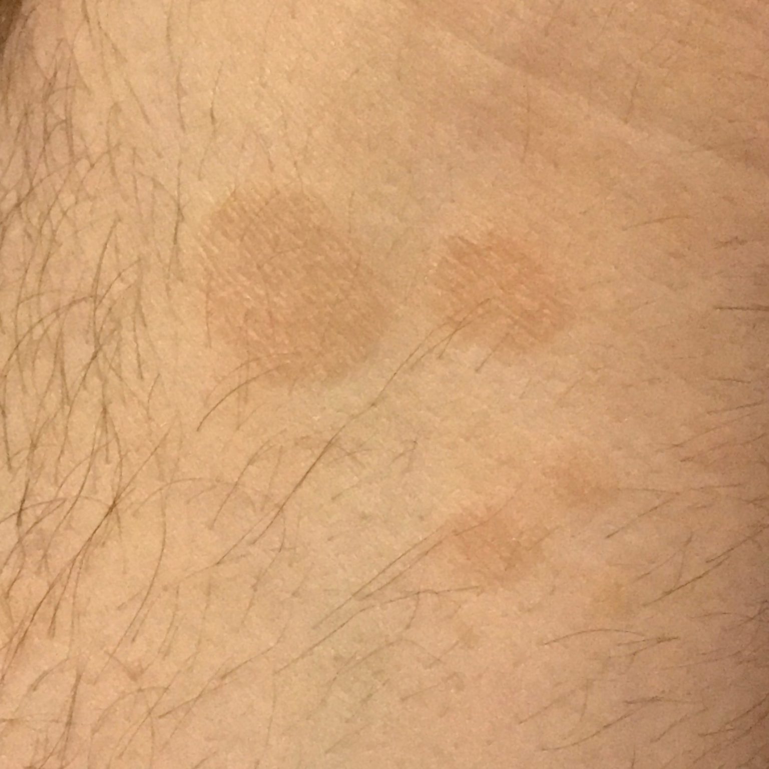 Pityriasis versicolor (ICD-10: B36.0) - Online consultation AI ...