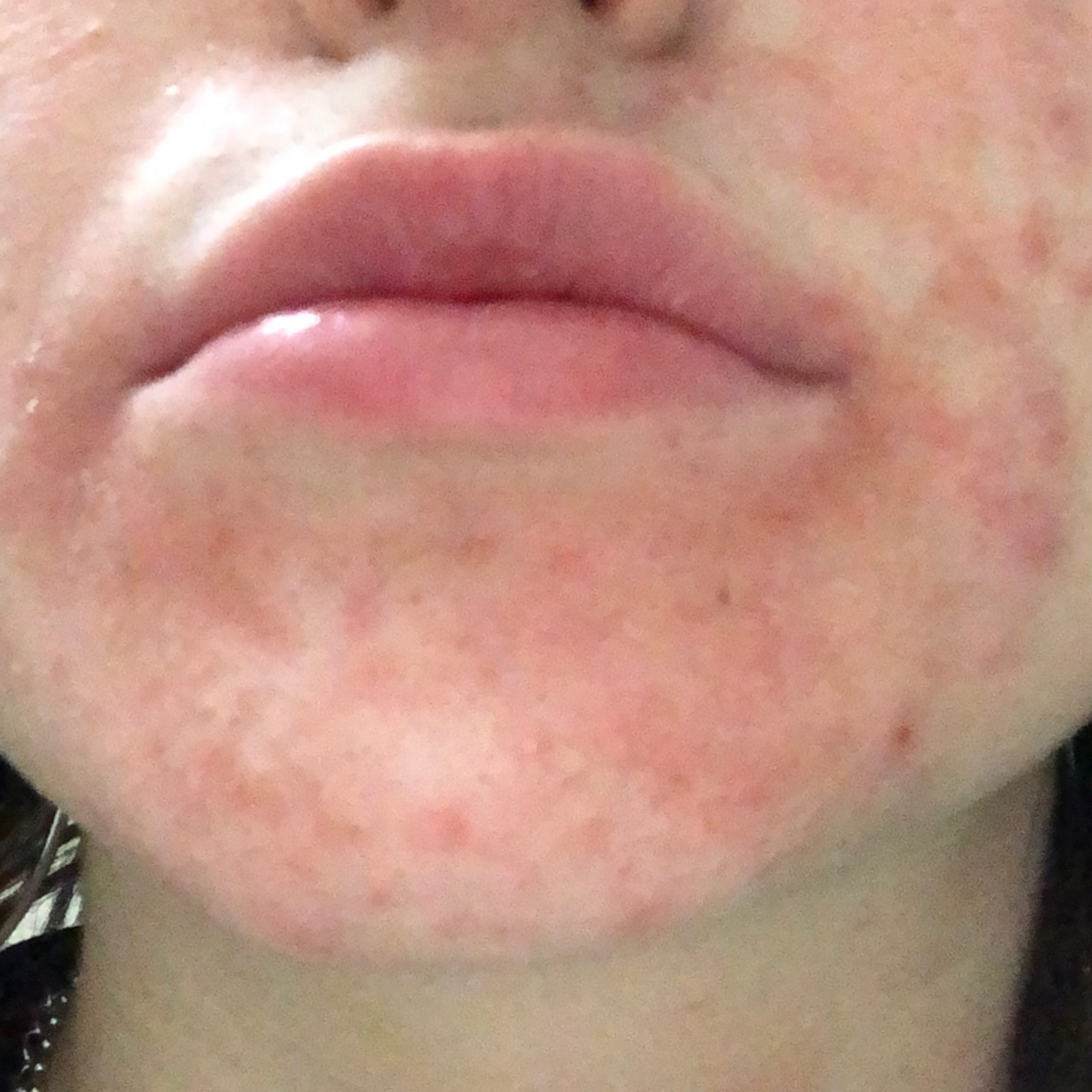 Dermatitis ICD 10 L20 L30 Online Consultation AI Dermatologist Dermatitis ICD 10 L20 L30 Online Consultation AI Dermatologist