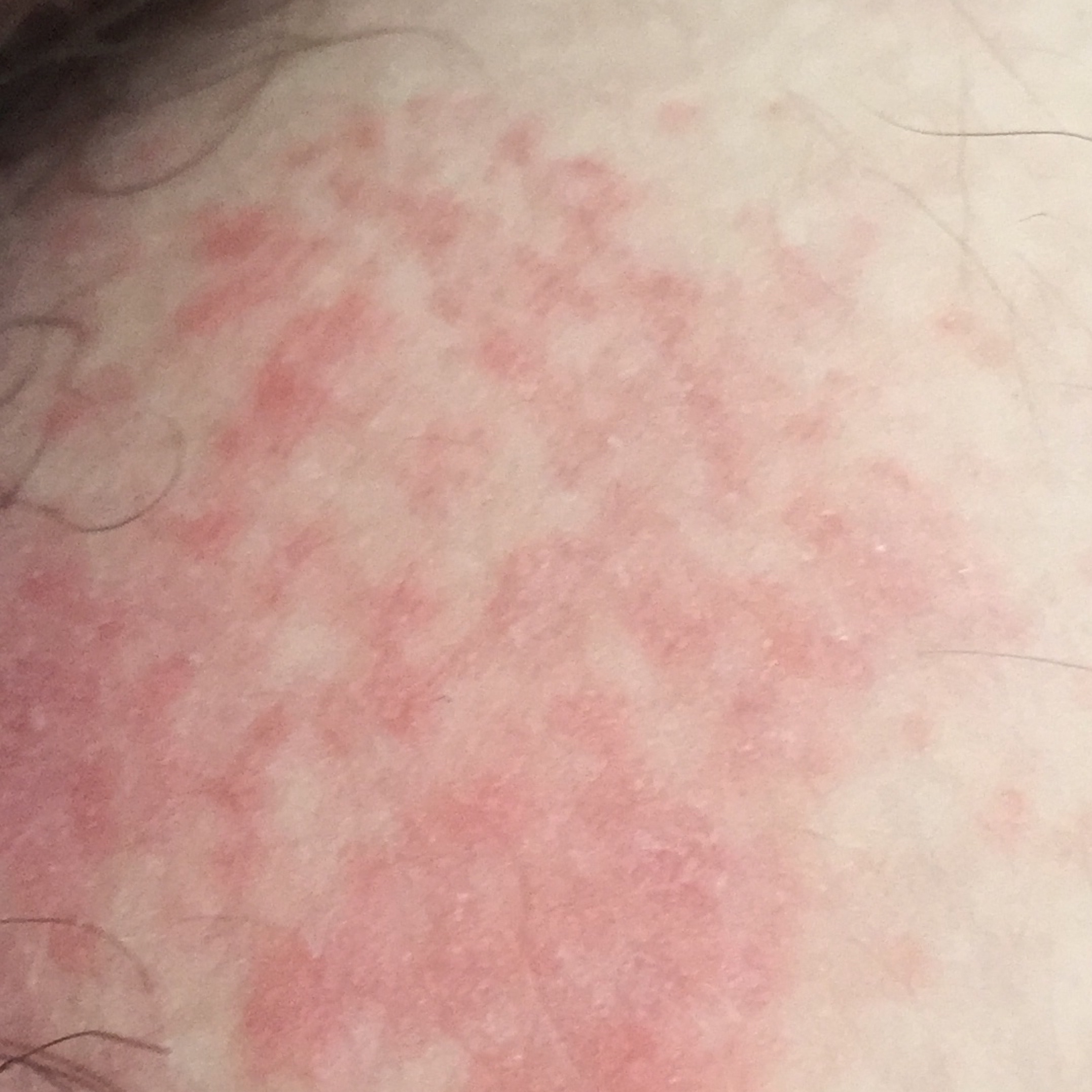 Dermatitis ICD 10 L20 L30 Online Consultation AI Dermatologist Dermatitis ICD 10 L20 L30 Online Consultation AI Dermatologist
