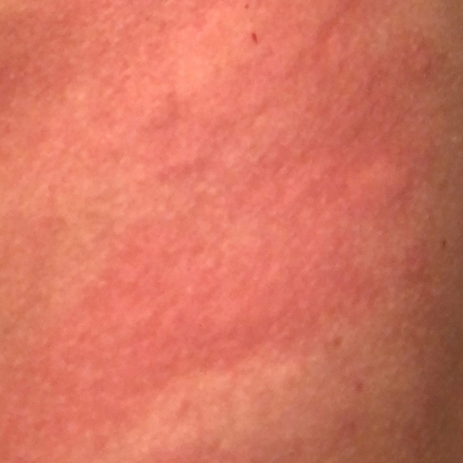 Dermatitis (ICD-10: L20-L30) - Online consultation AI dermatologist