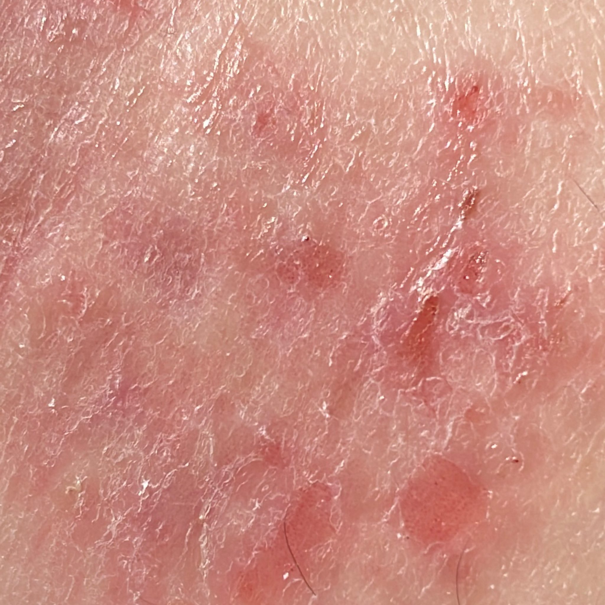 Eczema (ICD-10: L20-L30) - Online consultation AI dermatologist
