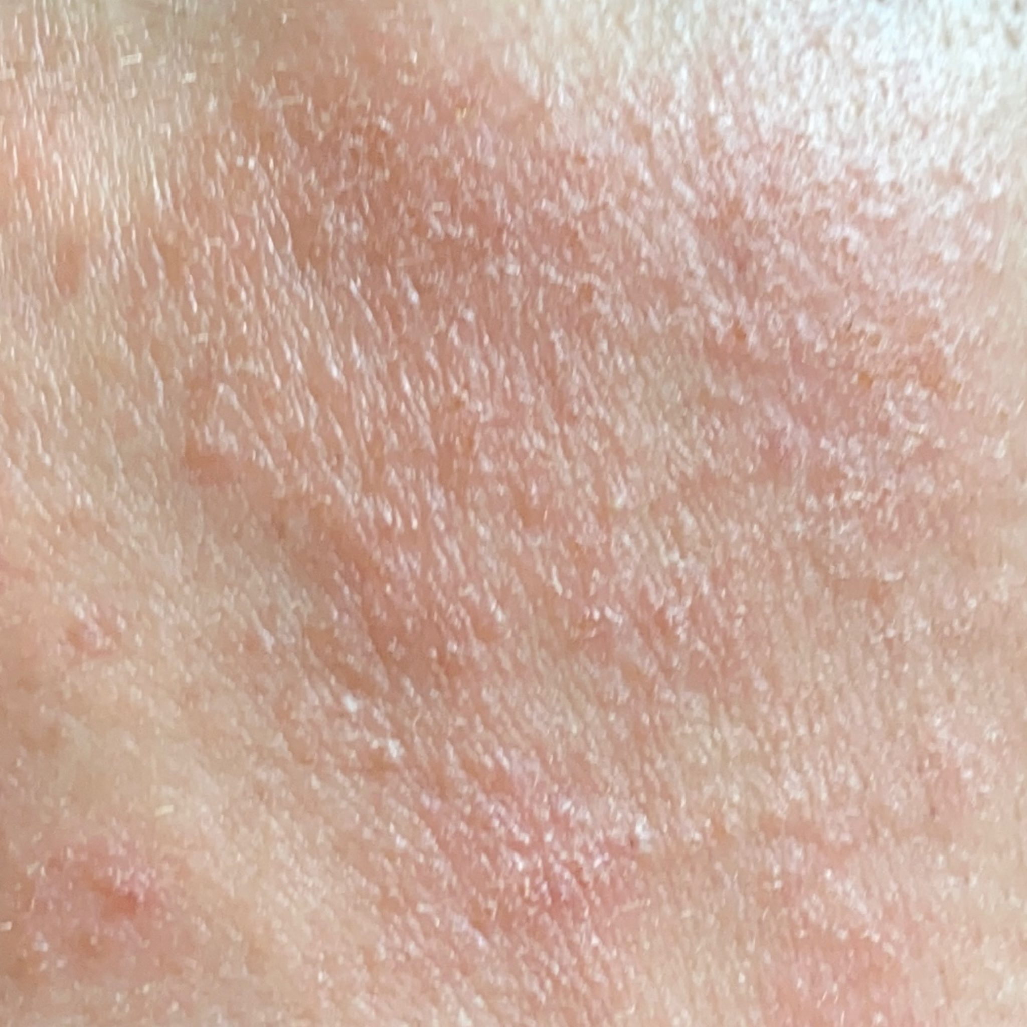Atopic Dermatitis (ICD-10: L20) - Online consultation AI dermatologist