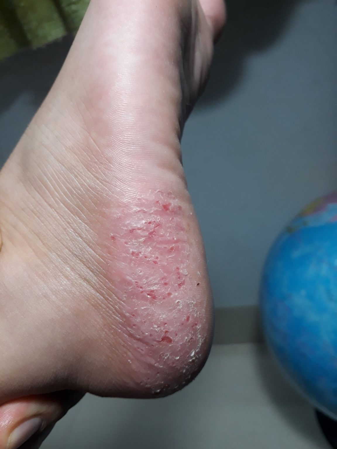 Eczema (ICD-10: L20-L30) - Online consultation AI dermatologist