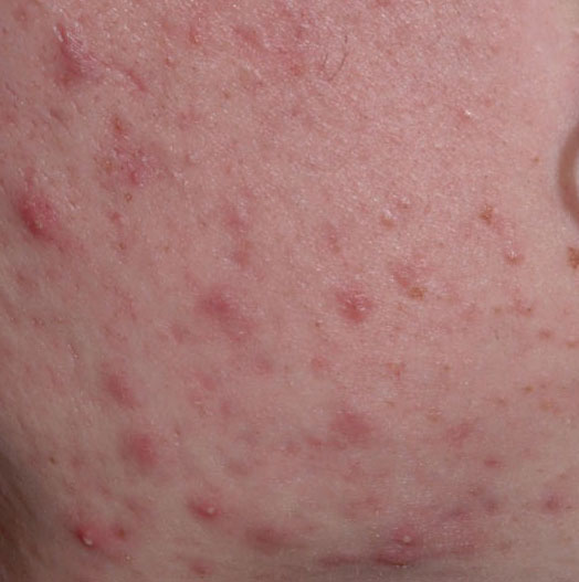 Acne Vulgaris ICD 10 L70 Online Consultation AI Dermatologist Acne Vulgaris ICD 10 L70 Online Consultation AI Dermatologist