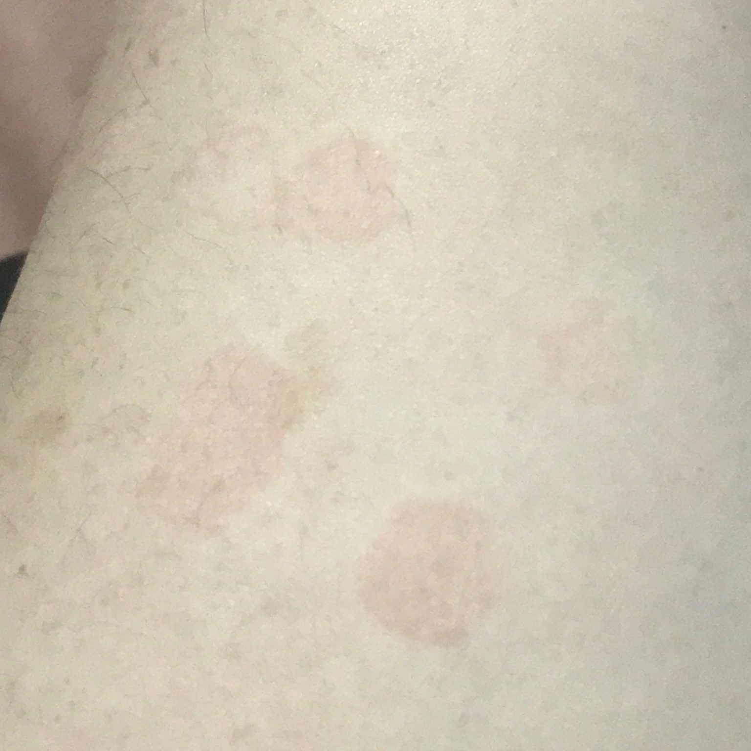 Pityriasis versicolor (ICD-10: B36.0) - Online consultation AI ...